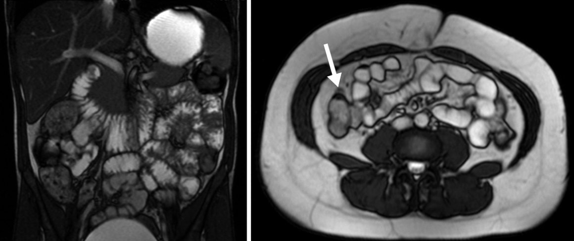ROL DE LA ENTERORRESONANCIA EN LA ENFERMEDAD DE CROHN