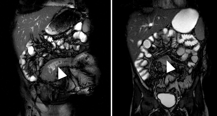 ROL DE LA ENTERORRESONANCIA EN LA ENFERMEDAD DE CROHN